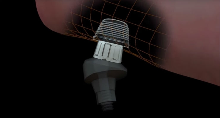 FDA Approves Rodo Abutment System, a Major Advance in Implant Dentistry ...