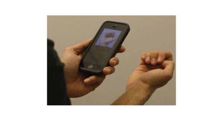 No Bleeding Required: Anemia Detection via Smartphone - Medical Product ...