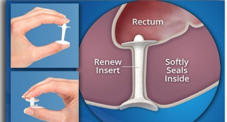 Renew Medical Launches New Solution to Help Prevent Accidental Bowel ...