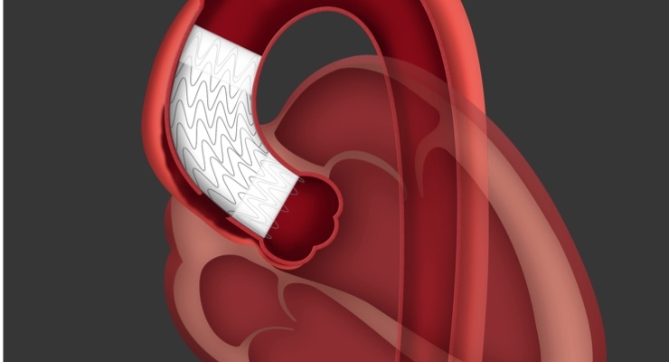 Gore Announces Successful Patient Implant of Endovascular Stent Graft ...