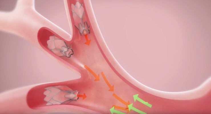 New Study Demonstrates Benefits of Pulmonx Zephyr Endobronchial Valve ...