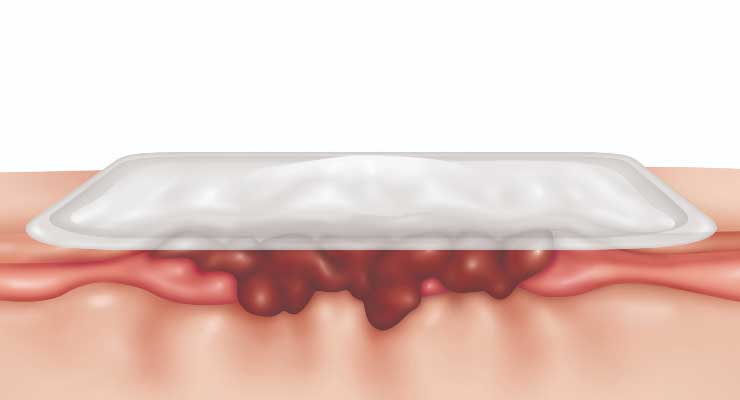 Role of Collagen in Wound Care - Medical Product Outsourcing