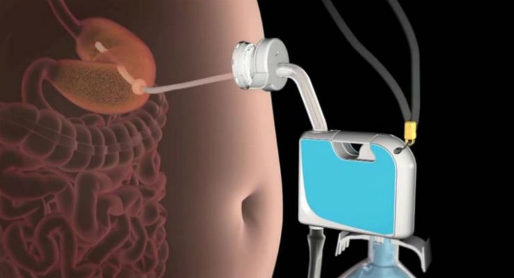 FDA Approves AspireAssist Obesity Device - Medical Product Outsourcing