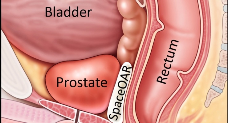 Augmenix Announces Positive SpaceOAR Clinical Trial Results - Medical ...