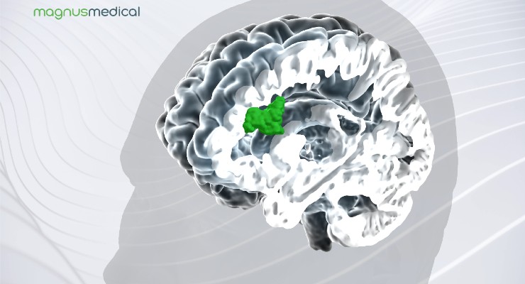 Magnus Medical's SAINT Neuromodulation System Gains FDA Nod for ...