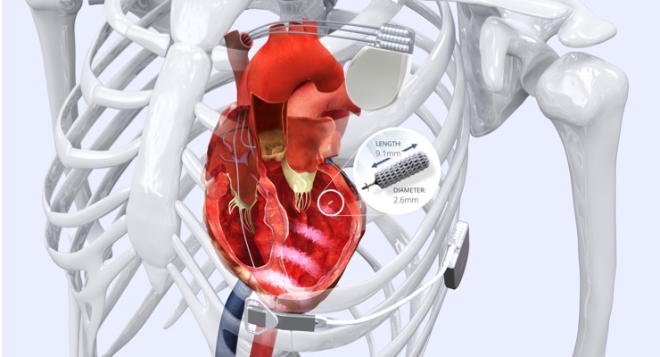 EBR Systems Initiates Global Trial of World’s Only Wireless CRT Pacing ...
