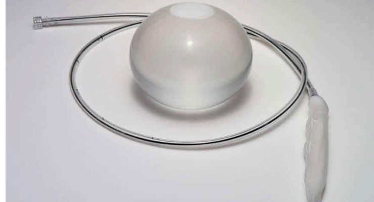Apollo Endosurgery's ORBERA365 12-Month Weight Loss Balloon Approved in ...