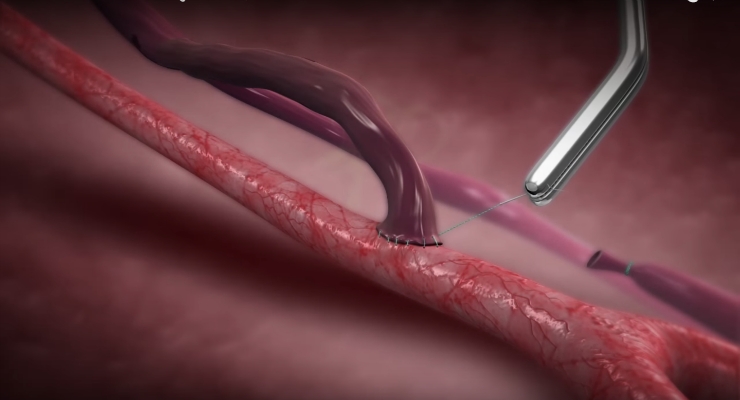Enrollment Complete in Trial of Arteriovenous Fistula Support Device ...