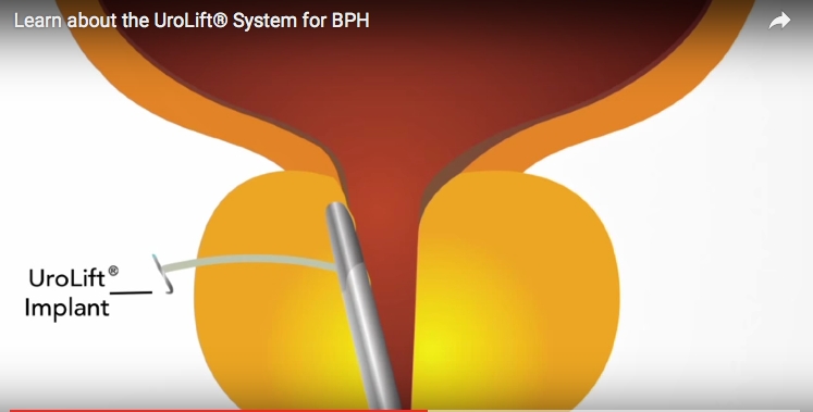 Data Show Excellent Durability of Results for NeoTract Inc.'s UroLift ...