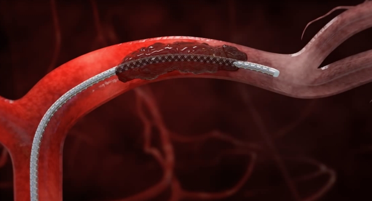 FDA Expands Stryker's Trevo Clot Retriever Treatment Window to 24 Hours ...