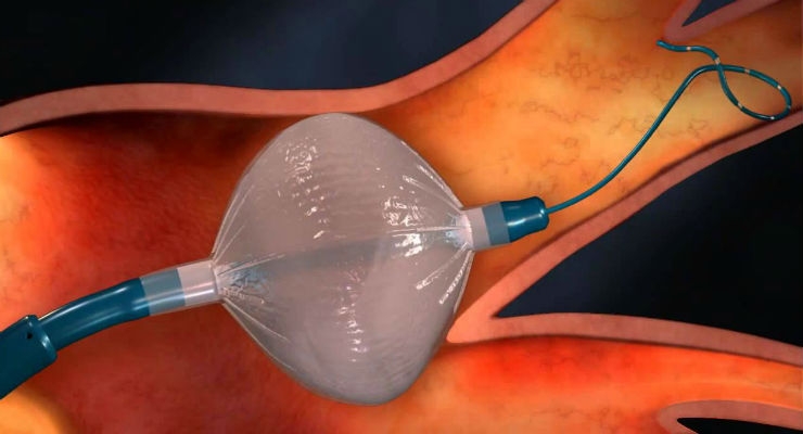 The Four P’s of AFib Ablation - Medical Product Outsourcing