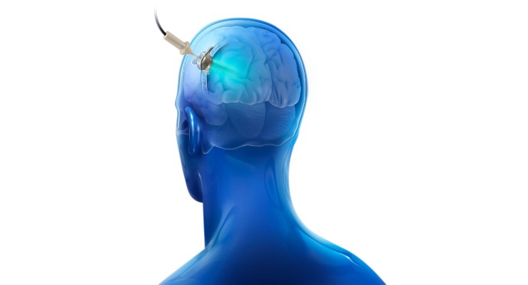 Carthera's SonoCloud Tech Shows Therapeutic Potential for Alzheimer's ...