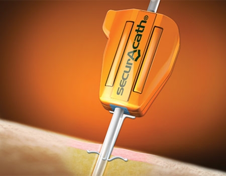 New Sizes of Interrad Catheter Cleared by FDA - Medical Product Outsourcing