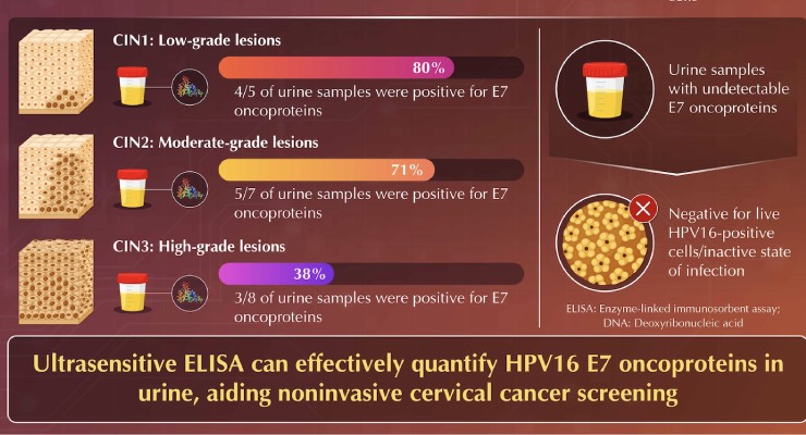 Researchers Develop Noninvasive Urine Test for Early Detection of ...
