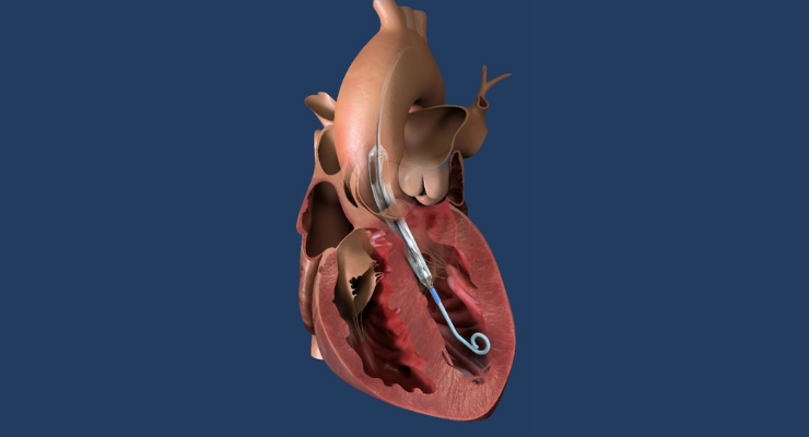 FDA Approves Impella ECP Pivotal Heart Pump - Medical Product Outsourcing