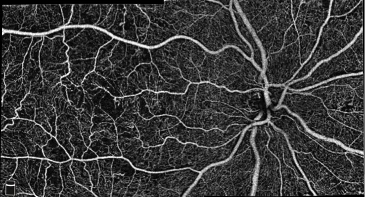 Optovue First to Release High Density OCT Angiography for Ophthalmology ...