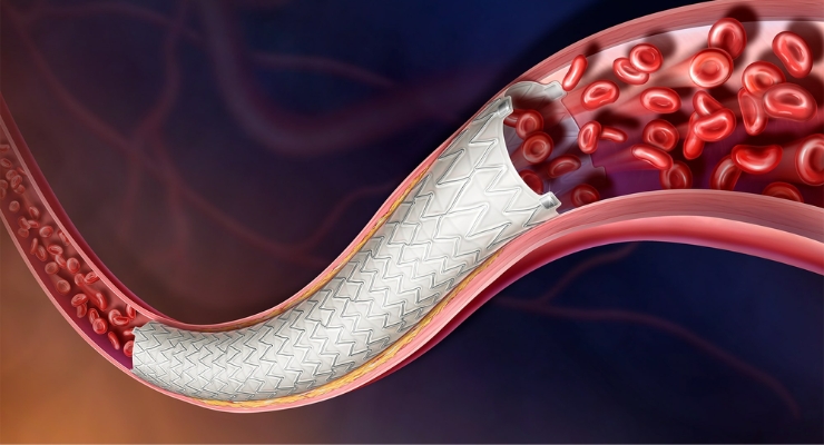 BD Begins AGILITY IDE Trial for Vascular Covered Stent - Medical ...