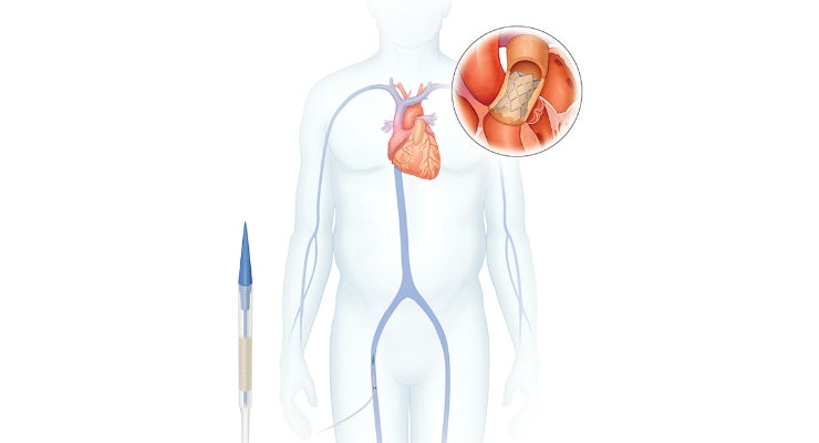Medtronic's Melody TPV Approved for Implantation in Failed Surgical ...