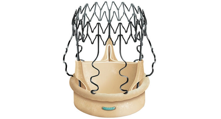 First U.S. Implants of Perceval Sutureless Valve - Medical Product ...