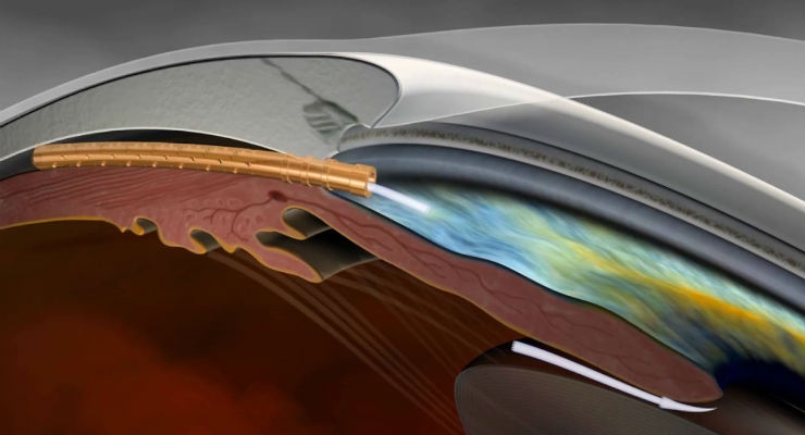 Alcon Withdraws CyPass Micro-Stent for Surgical Glaucoma from the ...
