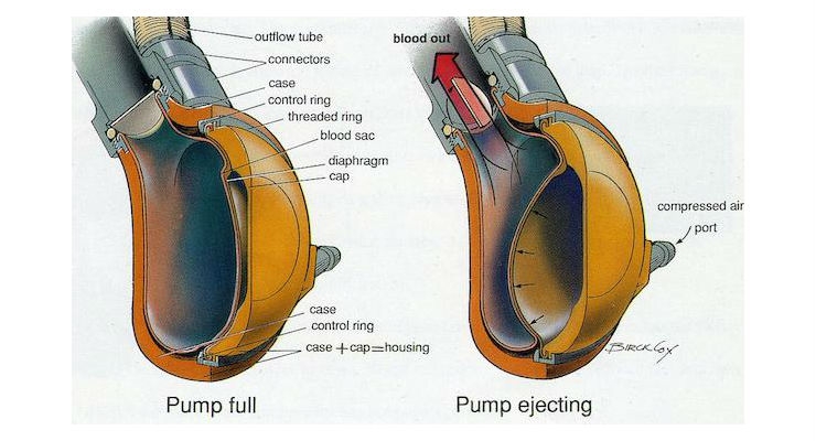Building a Safer Heart Pump - Medical Product Outsourcing