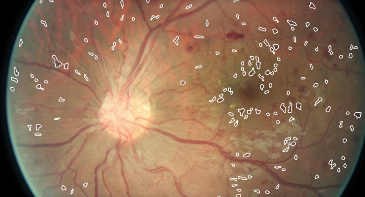IBM Machine Vision Spots Diabetic Eye Disease Early with Deep Learning ...