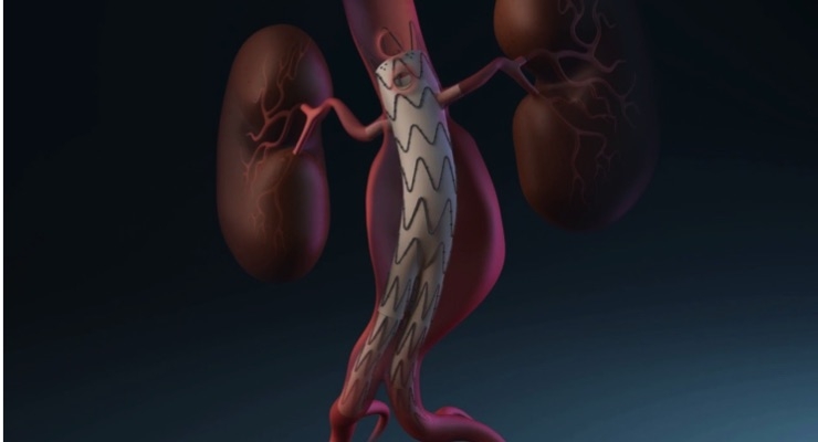 Aortica Corp. Reports Successful Results of EVAR Patients Using ...