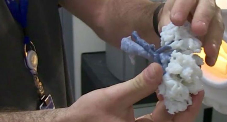 3D-Printed Kidney Helps Save Woman's Organ During Complicated Tumor ...