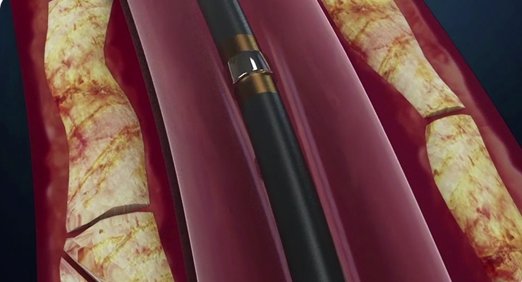 Shockwave Medical Announces U.S. Commercial Availability of Lithoplasty ...