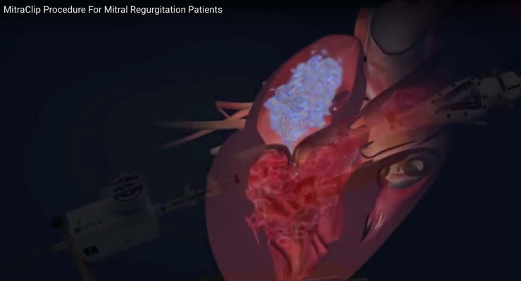 Abbott Buys Two Heart Valve Replacement Firms - Medical Product Outsourcing