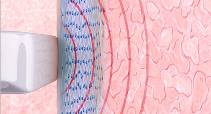 Viveve Announces Regulatory Approval for Viveve System in Singapore ...