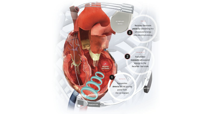 Heart Rhythm 2023: World's Smallest Leadless Pacemaker Shows Clinical ...