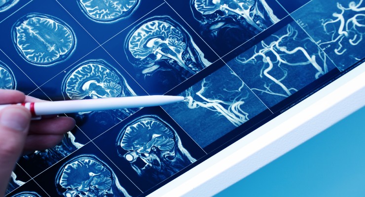 Cerus Endovascular's Contour Neurovascular System Gains Breakthrough ...
