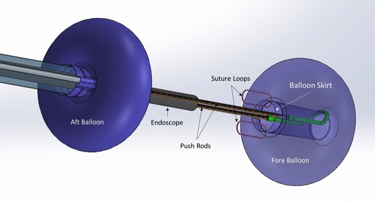 Lumendi Receives FDA 510(k) Clearance for Innovative DiLumen EIP Device ...