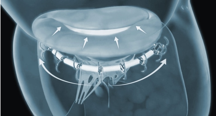 Ancora Heart Announces Positive Interim Analysis From Study of Heart ...