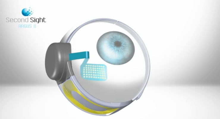 First Ever Combination of Robotic and Biological Vision in Humans ...