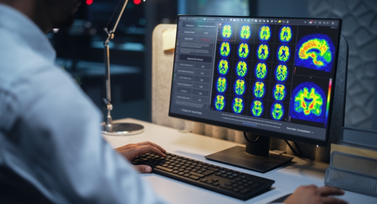 GE HealthCare's Brain Imaging Tool for Alzheimer's Wins FDA Nod ...