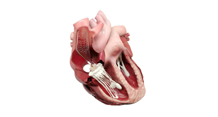 MedTech & Irrus Syndicates Lead Study Funding for CroiValve's ...