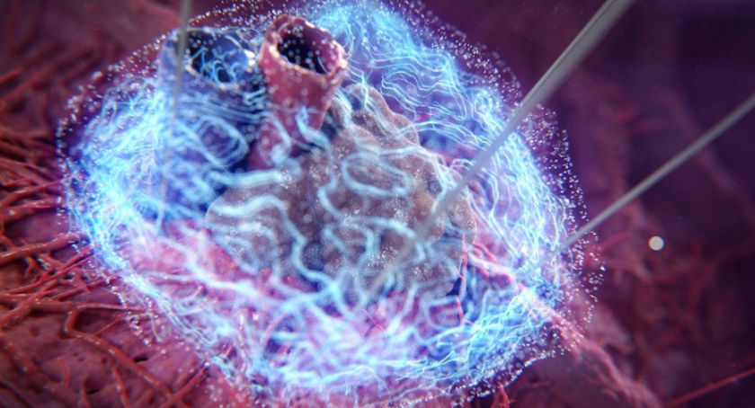 AngioDynamics' NanoKnife OK'ed for Prostate Tissue Ablation