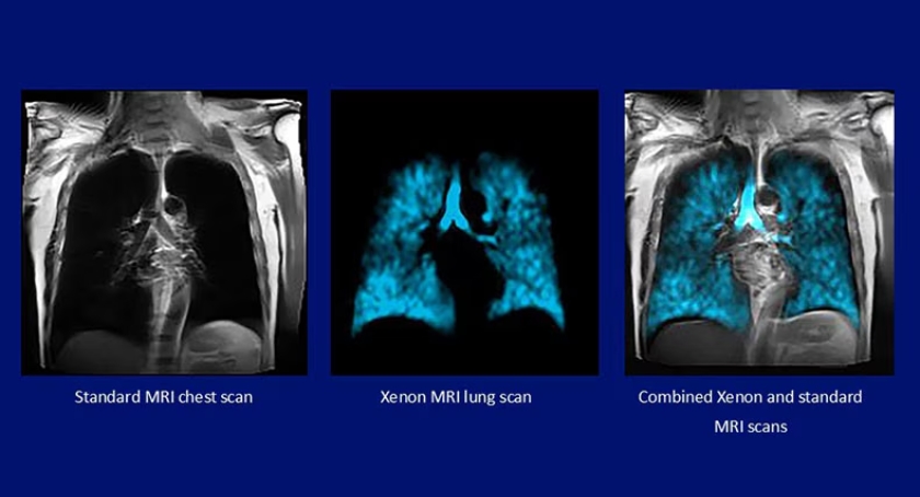 Philips, Polarean Partner on Xenon Lung MRI - Medical Product Outsourcing