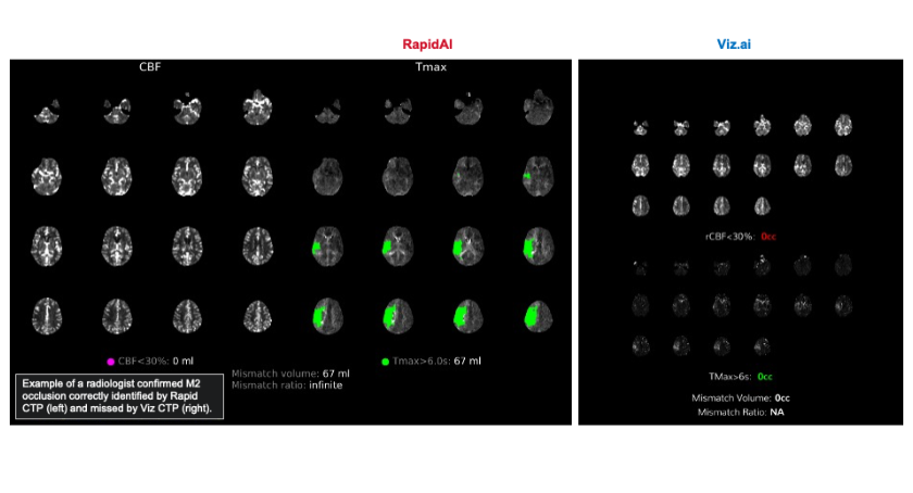 RapidAI Touts New Study Showing the Superiority of its Stroke Imaging ...