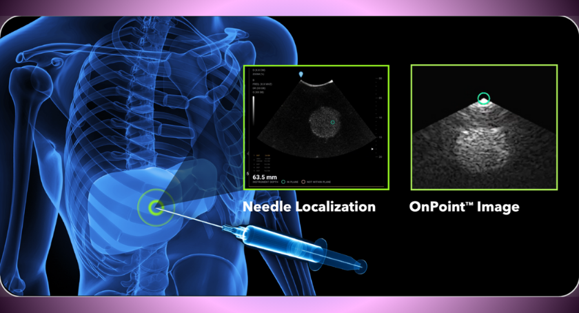 FDA Clears DeepSight's NeedleVue LC1 Ultrasound System - Medical ...