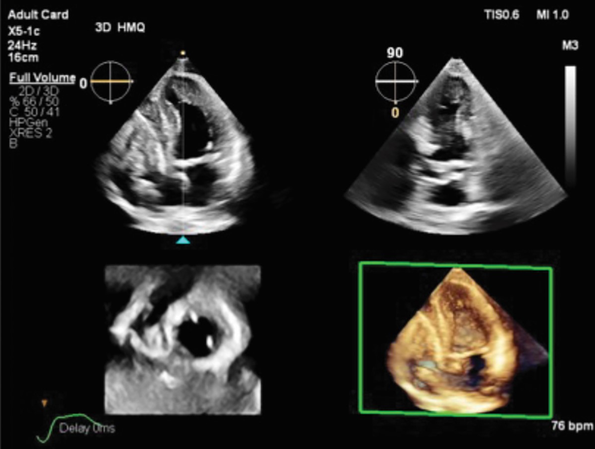 Philips Rolls Out Transcend Plus for EPIQ CVx and Affiniti CVx