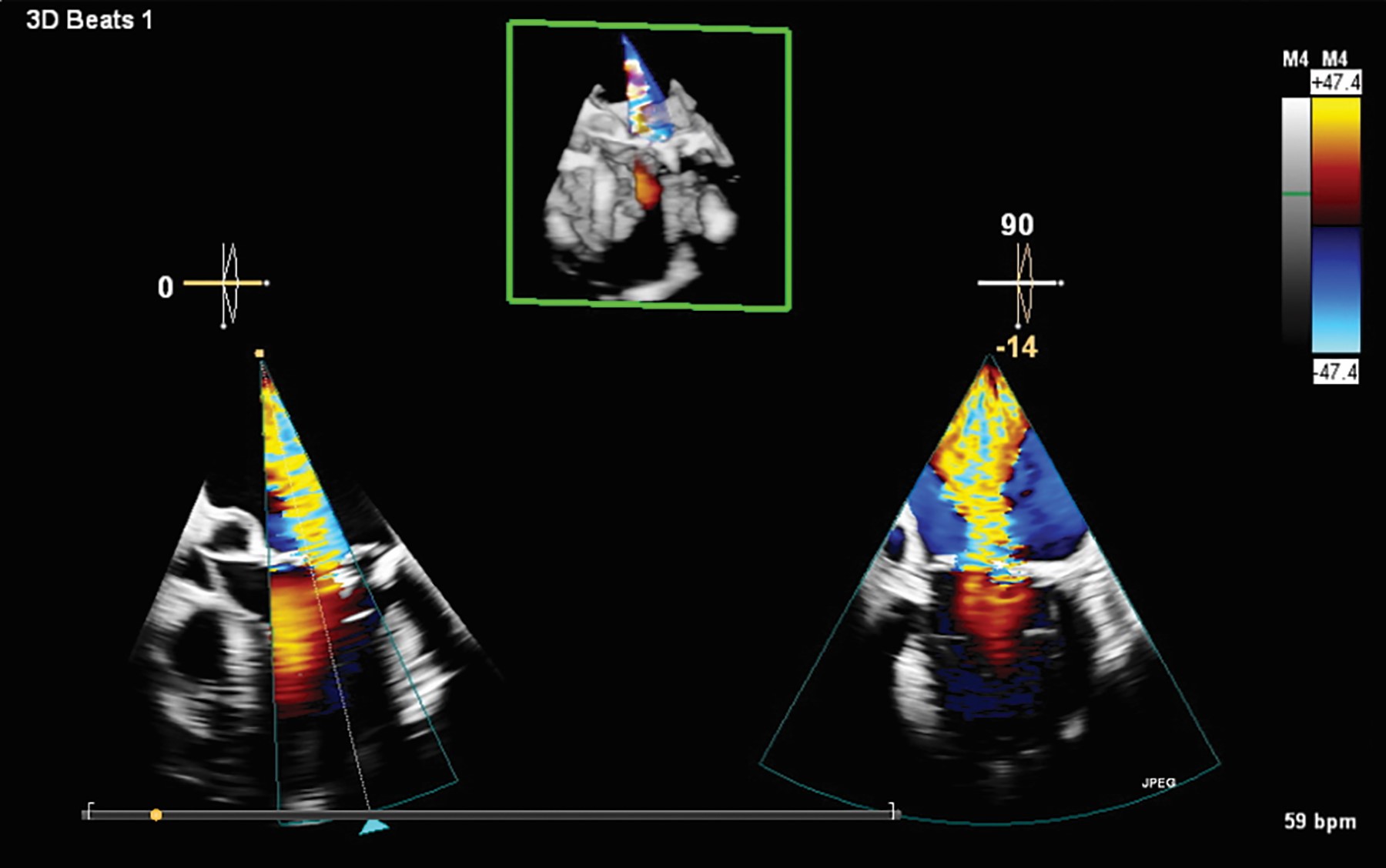 Philips Rolls Out Transcend Plus for EPIQ CVx and Affiniti CVx