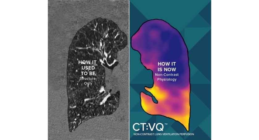 4D Medical Wins FDA Nod for CT:VQ Non-Contrast Lung Imaging