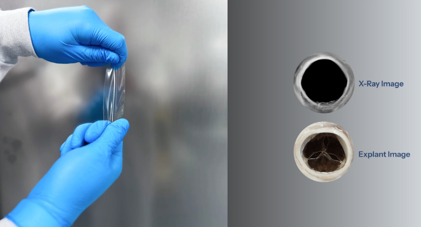 Foldax's TRIA Mitral Valve Hits Market in India - Medical Product ...