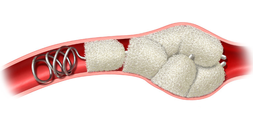 AAA-SHAPE Trial Enrollment Reaches Halfway Point - Medical Product ...