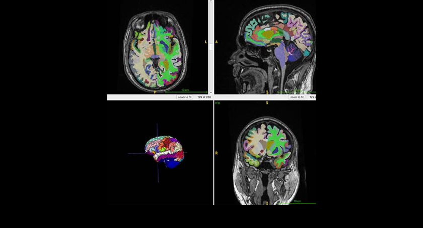 RSNA 2025: More Muscle, Less Belly Fat Slows Brain Aging - Medical ...