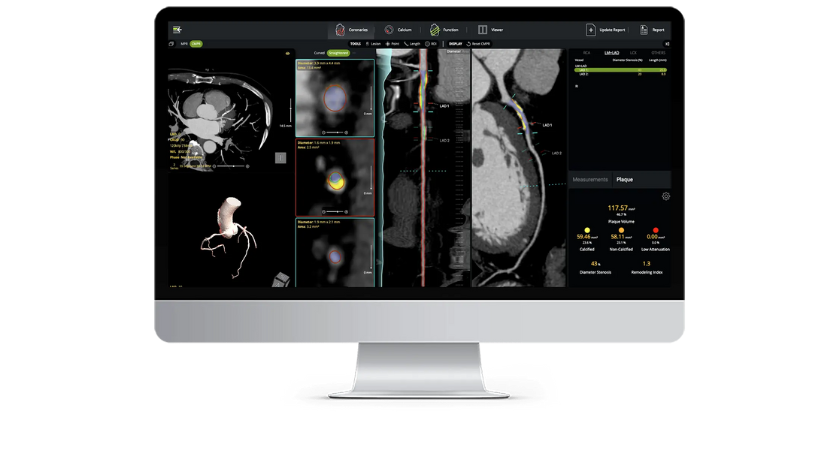 FDA Clears Circle Cardiovascular Imaging's cvi42 | Plaque Solution ...